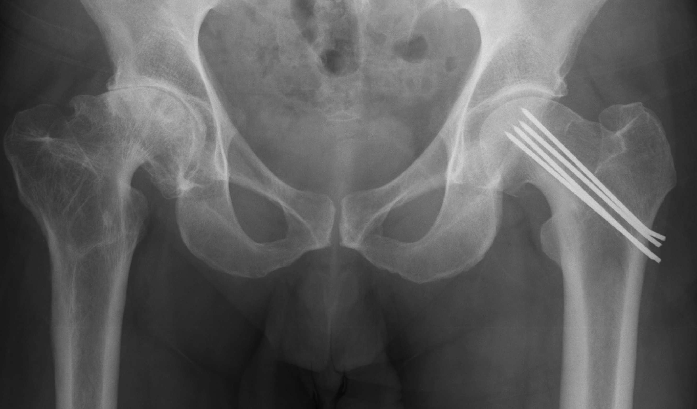 AVN | The Bone School